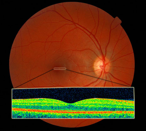 Macula Oct